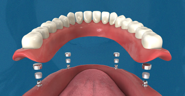 Accessories and Components for Overdenture Attachments: Ball and Loc