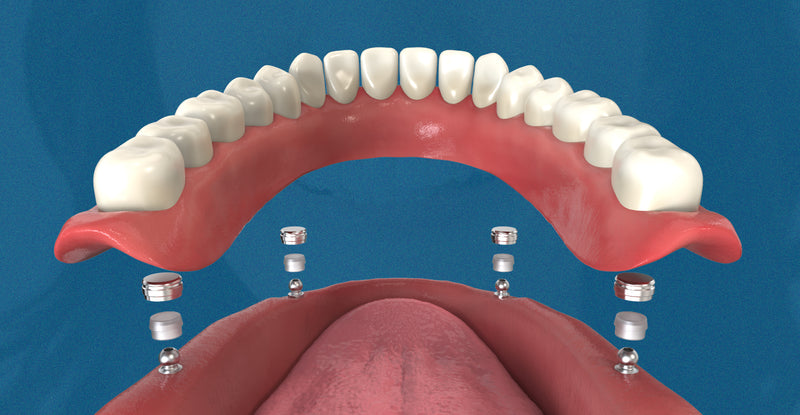 Accessories and Components for Overdenture Attachments: Ball and Loc